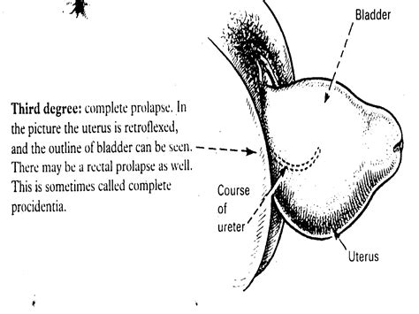 Uterine Displacementpptx Uterine Displacementpptx