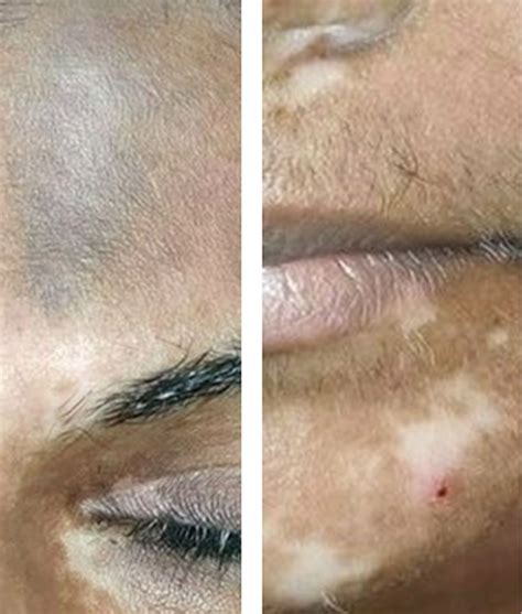 Linear Scleroderma Forehead