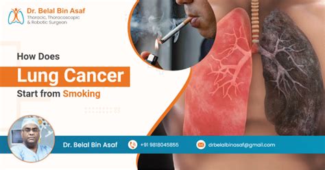 Lung Nodule Size Chart Dr Belal Bin Asaf