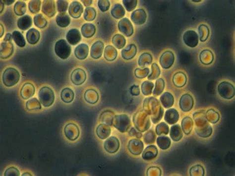 Atlas de sedimento urinario Urinarios Sedimentarias Hematíes