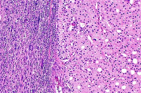 Case 98 Libre Pathology