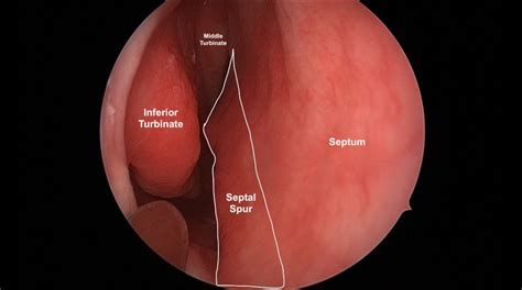 Nasal Turbinates Anatomy Ear Nose And Throat Before During And