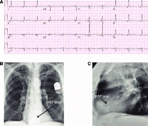 A A 12 Lead Ecg With Atrial And Selective His Bundle Pacing Qrsd 90 Download Scientific