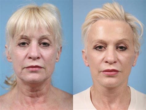 ‘ozempic® Face What To Do About Facial Aging And Sagging Skin After