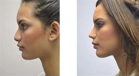 Upturned Nose Profile