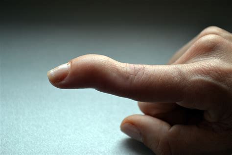 Mallet Finger Arlington Va Nirschl Orthopaedic Center