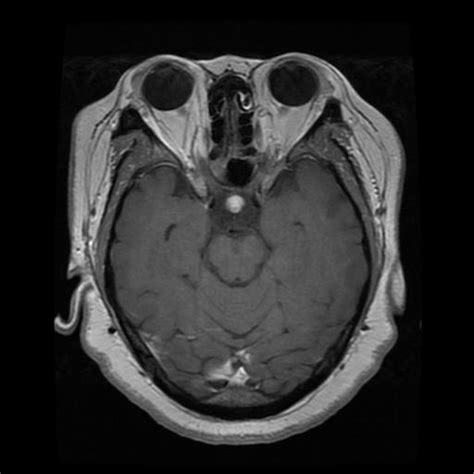 Tumor Detection Object Detection Dataset By Personal Projects