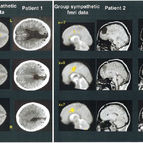 Pdf Human Cingulate Cortex And Autonomic Control Converging Neuroimaging And Clinical Evidence