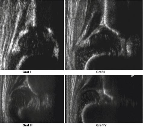 Evidence Based Management Of Developmental Dysplasia Of The Hip