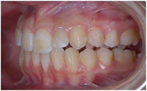 Left Side Centric Occlusion Download Scientific Diagram