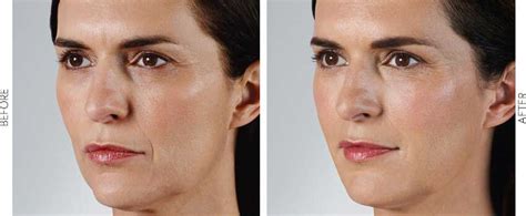 Prx T33 Next Generation Chemical Peel Mill Valley Ca