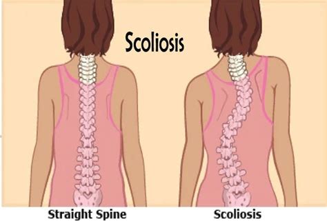 The Different Types Of Scoliosis And How They Affect The Body