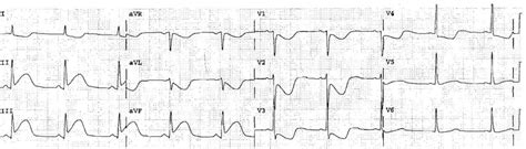 Ecg Case 146 Diffuse Subendocardial Ischemia Manual Of Medicine