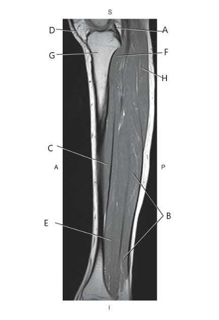 Sagittal T1 Weighted Mri Of Tibia Diagram Quizlet