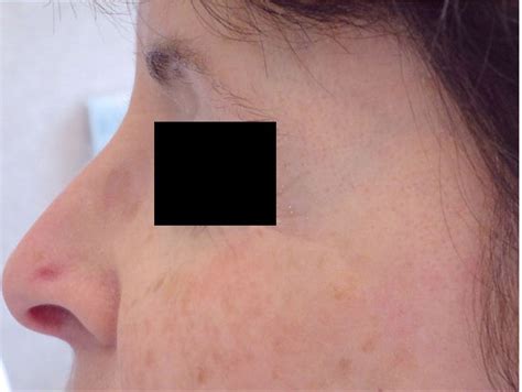 Excision Fairfield Dermatology