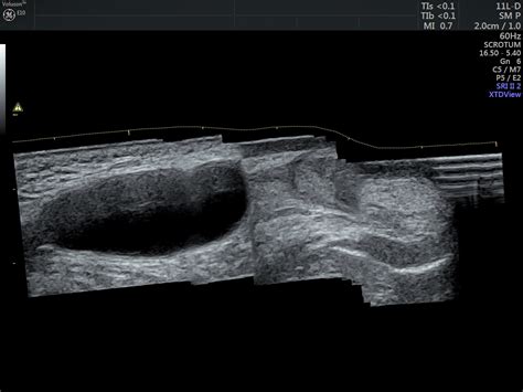 Spermatic Cord Hydrocele Looking Through A Transducer