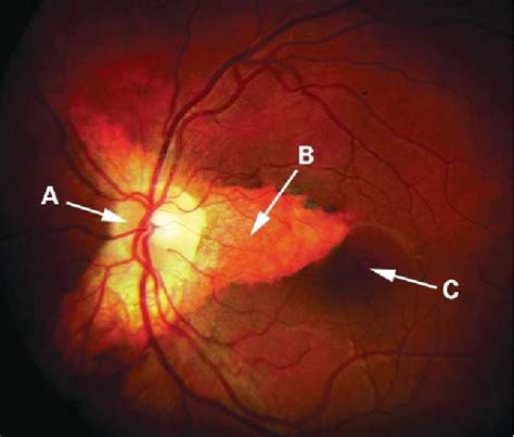 Chorioretinal Atrophy Semantic Scholar