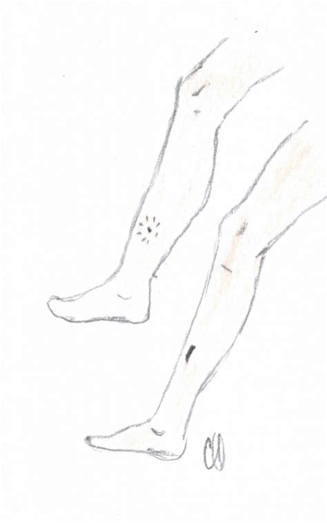 Open Fractures Gustilo Anderson Classification