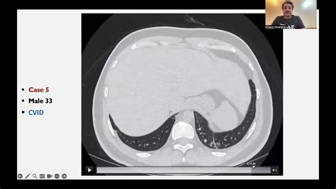 Diffuse Bronchiectasis Part 3 Arabic Version Youtube