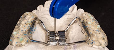 The Palatal Expander How To Use How Does A Palatal Expander Widen