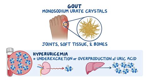 Gout Clinical Sciences Osmosis Video Library