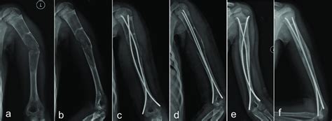 Pathological Fracture Of The Humerus A B With Deformity Due To Ubc Download Scientific
