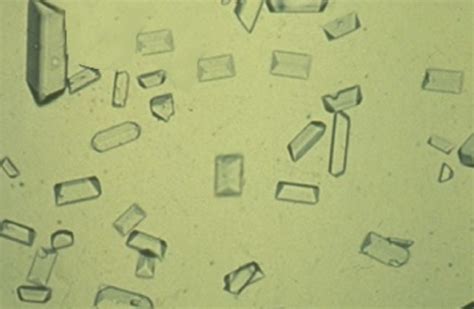 Urinary Calculi Flashcards Quizlet