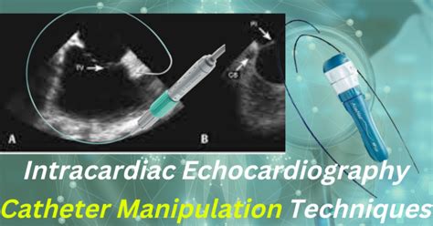 Intracardiac Echocardiography Catheter Manipulation Technique Medfoxes