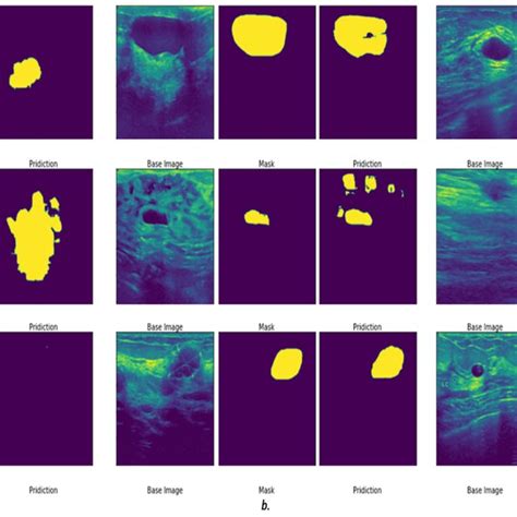 Preliminary Results Indicate A Promising Outcome Of Automated Breast Download Scientific