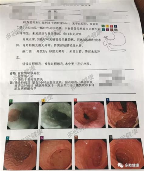 食管胃粘膜异位症 巴雷特食管图片怎么看 rrt食管图片 大山谷图库