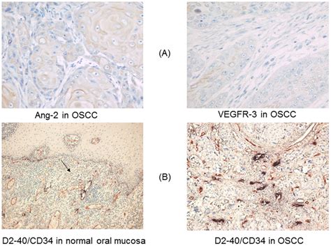 Immunohistochemical Expression Of Ang 2 And Vegfr 3 In Oscc