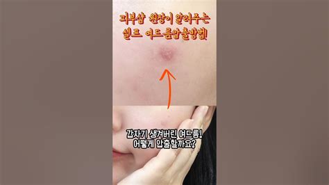 피부샵 원장이 알려주는 여드름 짜기🪡 여드름압출 동영상📹 여드름압출후관리까지🔥 Youtube