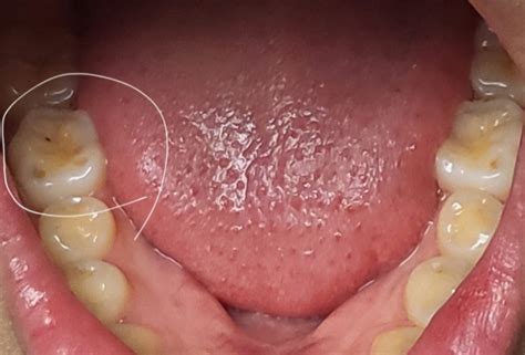 치아에 검은점 지식in