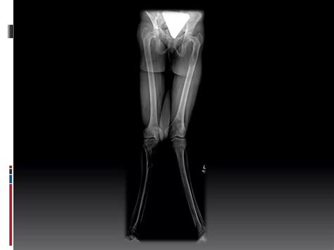 Plain Radiological Findings Of Primary Hyperparathyrodism Pptx