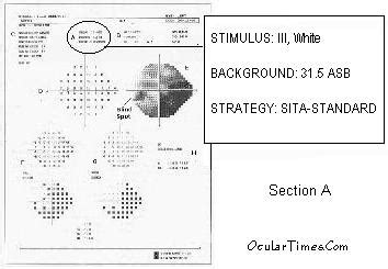 Visual Field Testing
