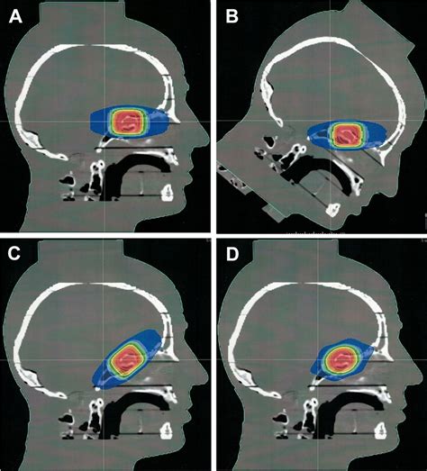 Dose Distribution Map At A Tilt Angle Of 0° A Deformable Image
