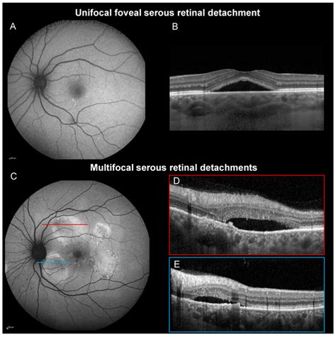 A B Central Serous Chorioretinopathy Cscr With A Unifocal Macular