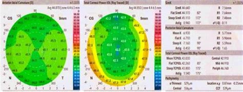Topografía Corneal Del Ojo Izquierdo El Mapa Queratométrico Mostró Un
