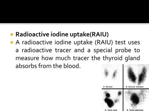 Hyperthyroidism PPTX Thyroid Disorders Endocrine And Metabolic Diseases