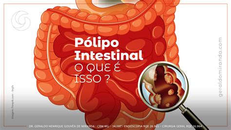 Pólipo Intestinal O Que é Isso Blog Dr Geraldo Henrique Gouvêa De