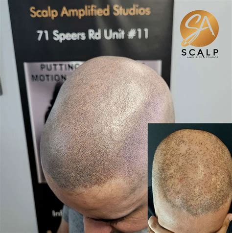 Scalp Micropigmentation Before And After Examples Scalp Amplified