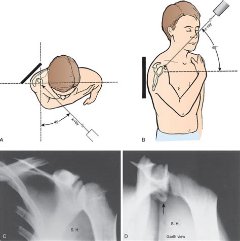 Shoulder X Ray Positioning Y View At Jason Rocha Blog