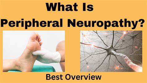 What Is Peripheral Neuropathy Best Overview Good Health Tube A Production Of