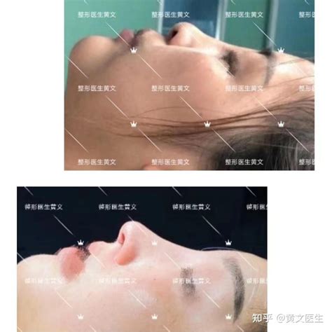 隆鼻会塌脸吗？隆鼻之后脸会塌吗？隆鼻材料如何选择？ 知乎