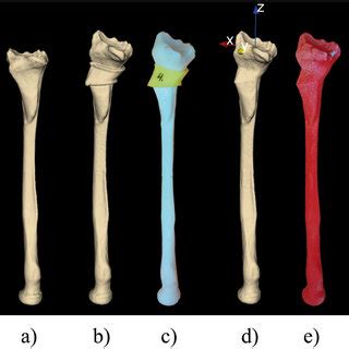 A Virtual Representation Showing An Example Of A Deformed Bone B