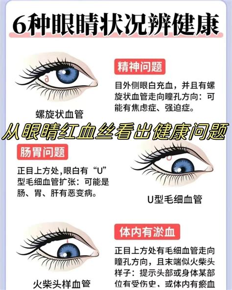 从眼睛红血丝看出健康问题