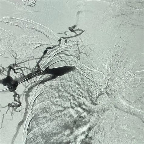 Peripheral Angioplasty Test Cost In Ludhiana India Peripheral Angiography Surgery In Punjab