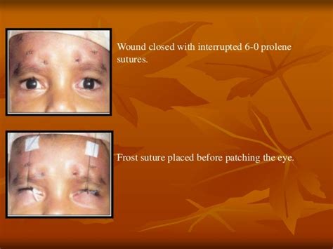 Ptosis Surgery