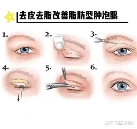肿眼泡如何做双眼皮才好看？ 知乎