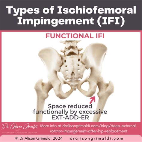Deep External Rotator Impingement After Hip Replacement Find Out More